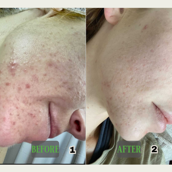 Patient Photographs – Hempability®